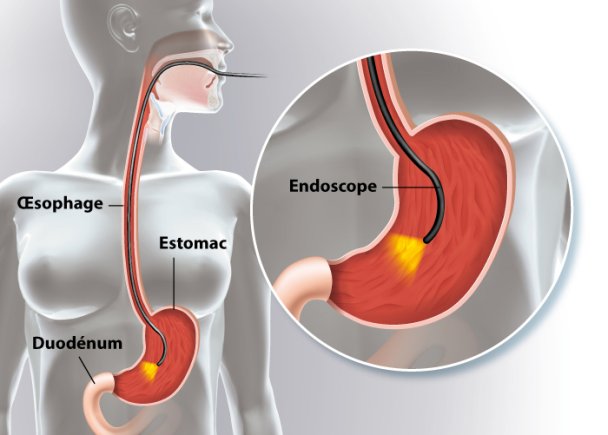 Fibroscopie | Clinique Jean le Bon